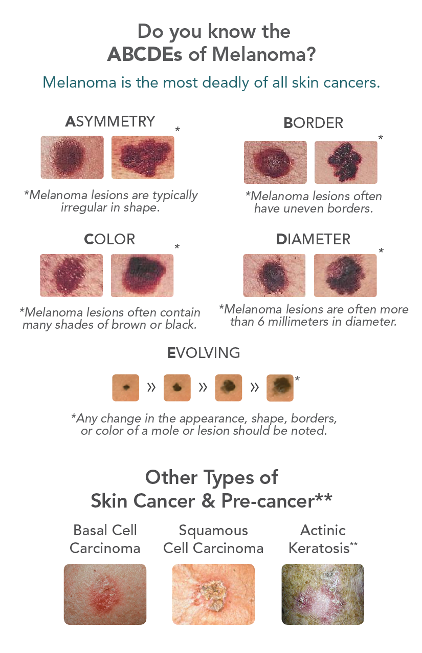 Skin Cancer Risks and Preventative Measures – Nursing Notes